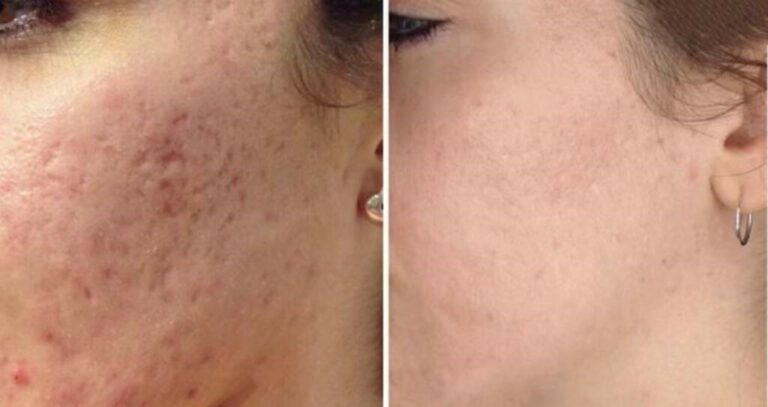 Fractional Laser (littekentherapie) - Venus Laser & Huidkliniek