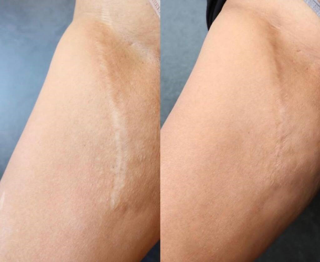 Fractional Laser (littekentherapie) - Venus Laser & Huidkliniek